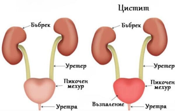 ᐉ Цистит - причини, симптоми и лечение | Kolastra.eu